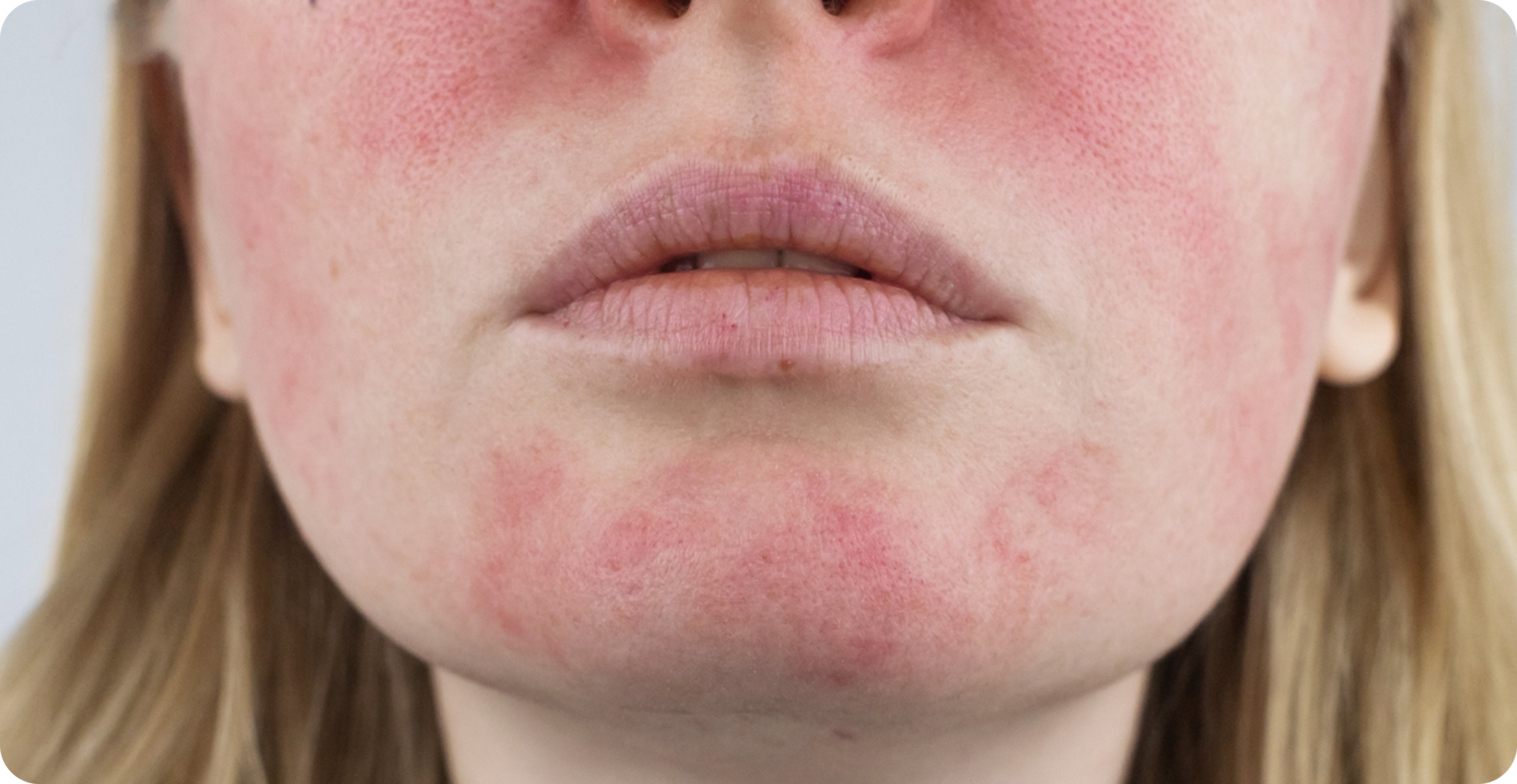 Can You Drink Alcohol While on Accutane? - Clear Health
