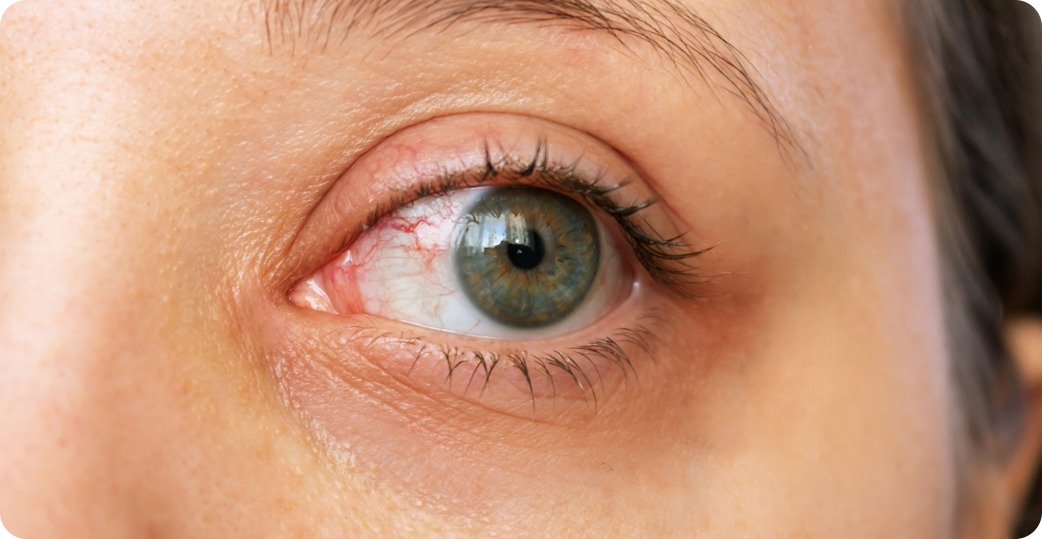 Do You Need Blood Tests for Accutane? | Clear Health