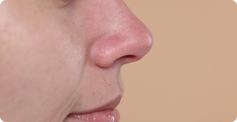 Can You Drink Alcohol While on Accutane? - Clear Health