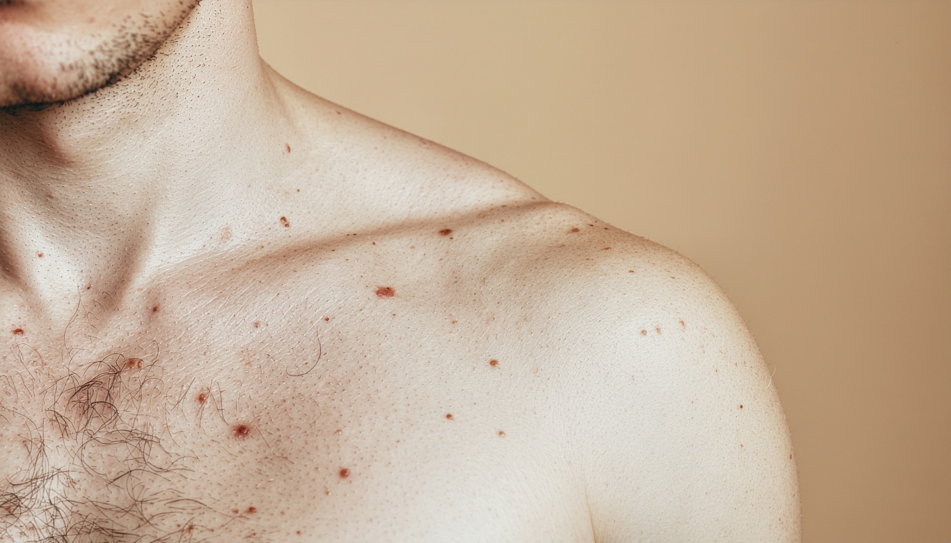 Doxycycline Acne Treatment Duration: What to Expect - Clear Health